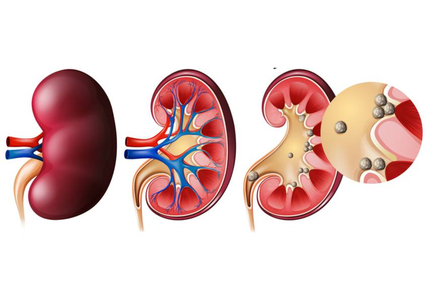 RIRS vs URS vs PCNL – Which Stone Treatment Is Right for You? – Dr ...